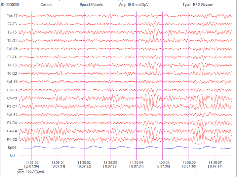 Elektroencefalografija (EEG) - Neurology.lt